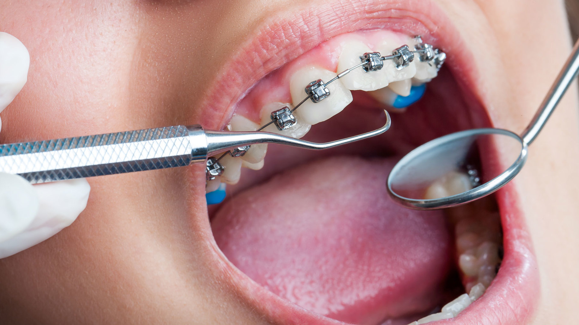 Expert Orthodontics Treatment For Your Smile At Cidentist Expert Orthodontics Treatment For Your Smile At Cidentist