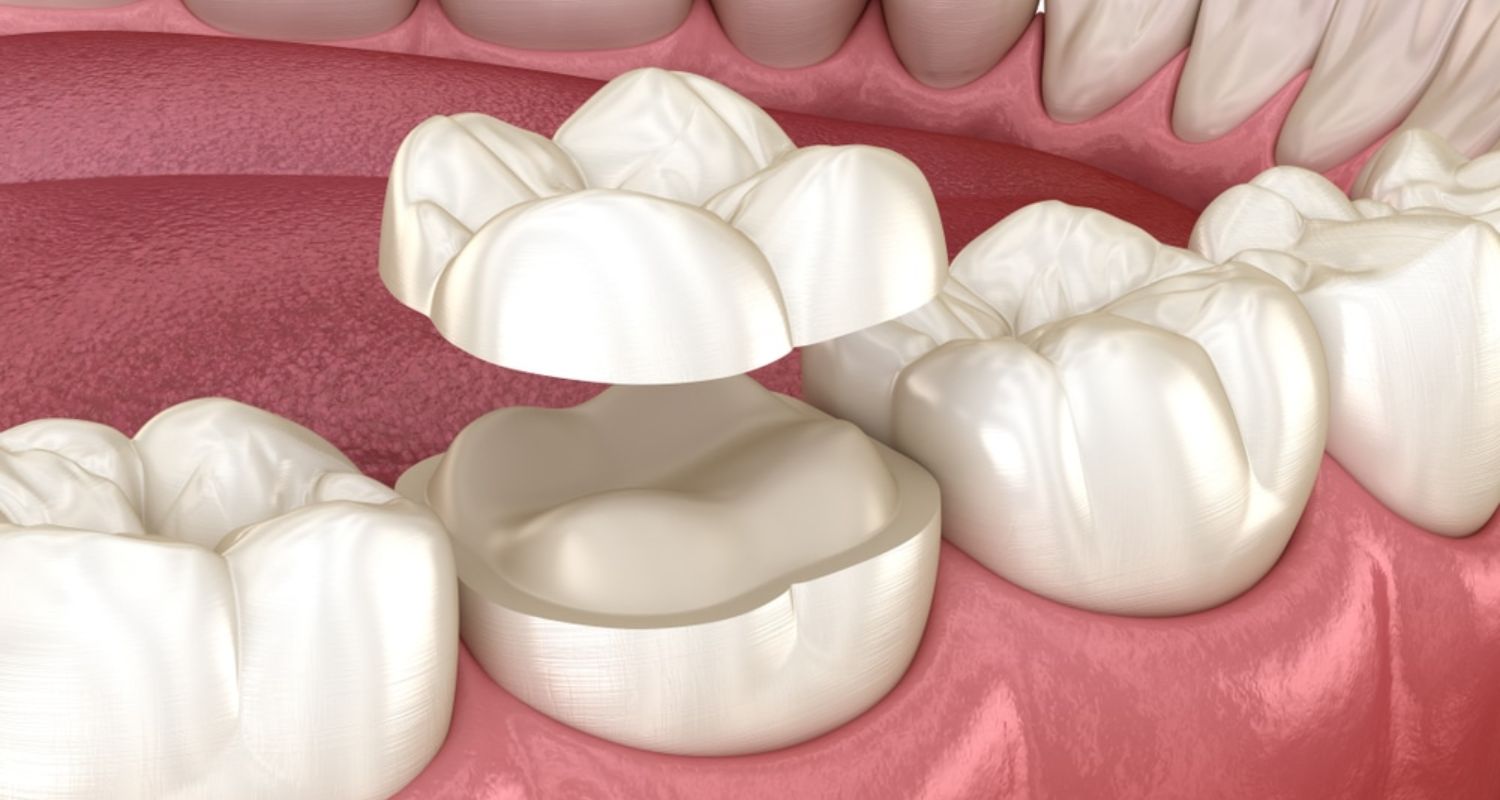 What Is An Onlay | 6 Benefits Of Dental Onlays